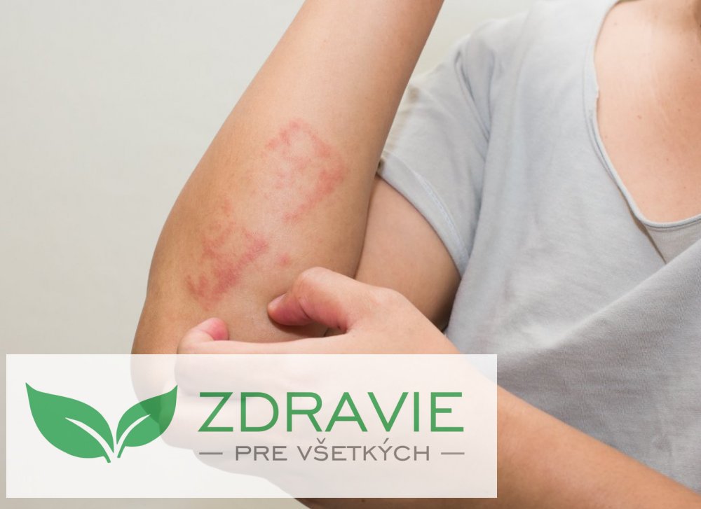 Dermatitída :: Zdravie pre všetkých